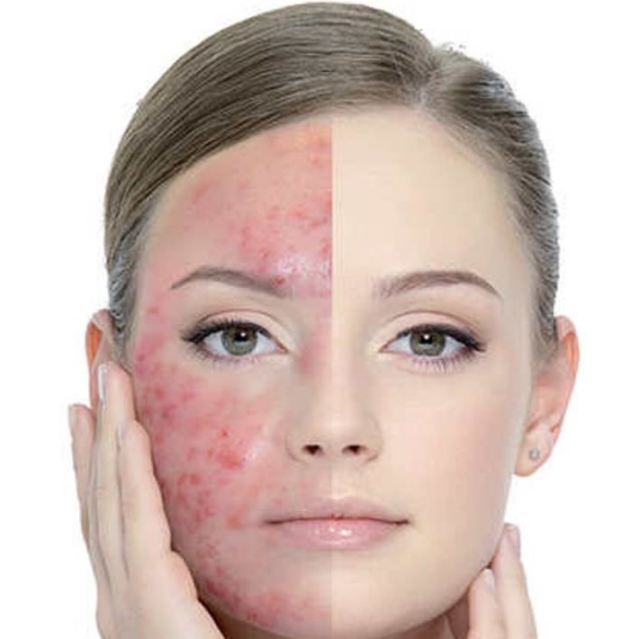 Quais os principais cuidados a ter na pele com acne? – Sonia Coelho ...